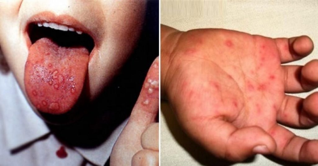 UZMANĪBU! Tūristi no Turcijas var atvest briesmīgo Koksaki vīrusu ...